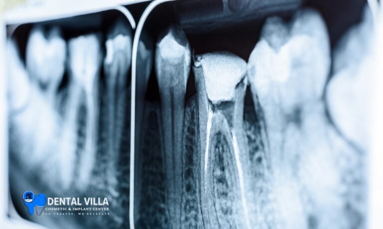 Single-Sitting vs. Multiple-Sitting Root Canal Treatment: A ...